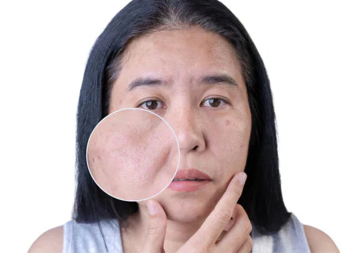 How Effective is Microneedling for Hyperpigmentation and Dark Spots ...