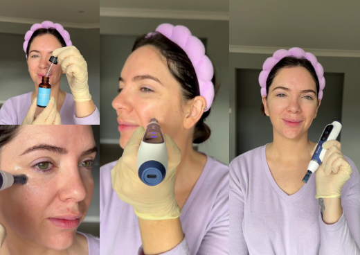 Your Quick & Easy Guide to Microneedling: Why It Is Worth the Hype – Dr ...